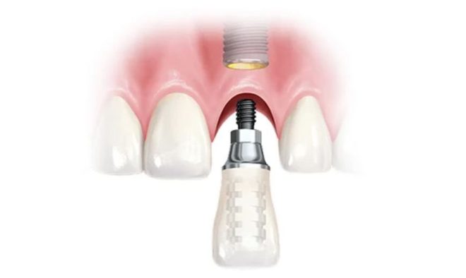 Same day teeth implants⭐️Immediate placement, loading (teeth in a day)